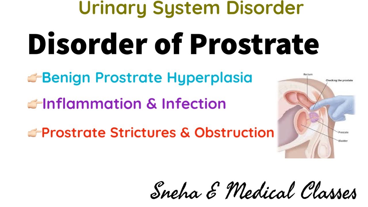 Disorder of Prostrate !! Urinary System !! Causes !! Sign & Symptoms ...