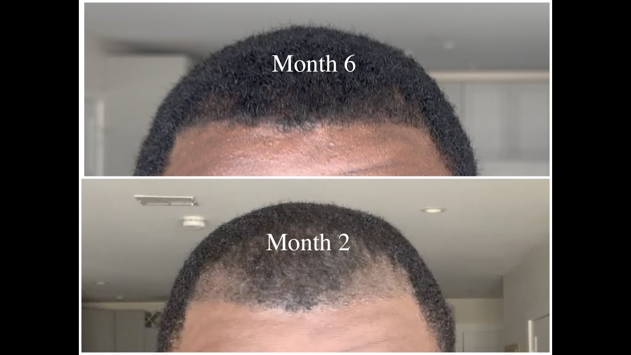 Afro Hair Transplant | 6 Months Update | Am I Satisfied? - YouTube