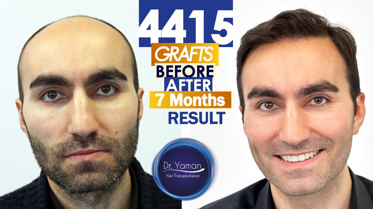 4415 Grafts 7 Months Hair Transplant Before After Result | Dr Resul ...