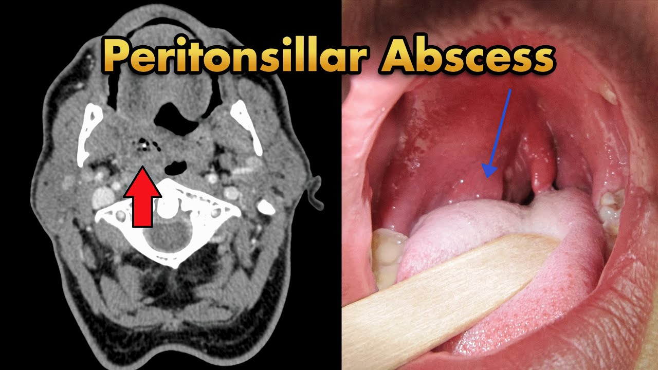 Peritonsillar Abscess (Quinsy): Pathophysiology, Clinical Features, Diagnosis and Treatment ...