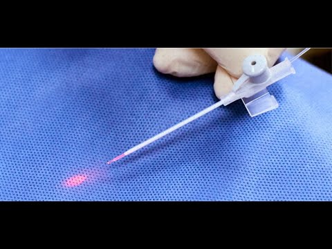 Endolaser... técnica minimamente invasiva para tratamento das varizes ...