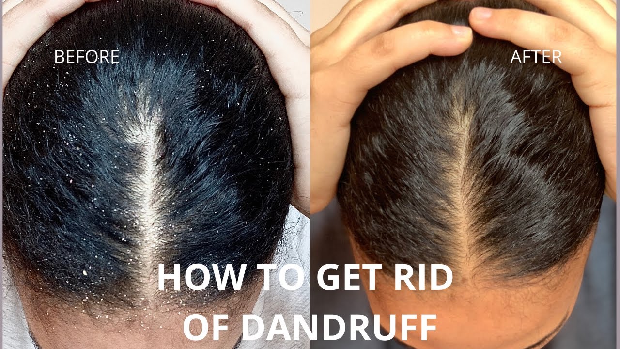 HOW TO GET RID OF DANDRUFF - YouTube