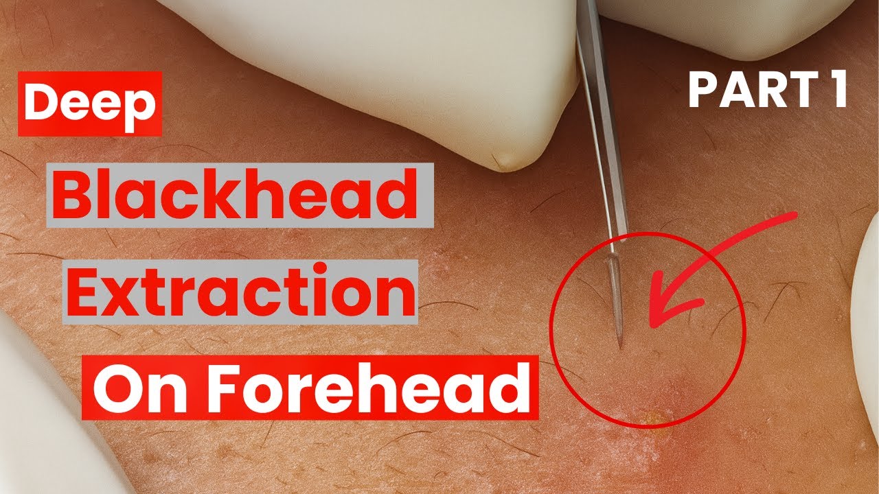Deep Blackhead Extraction on Forehead - Extremely Satisfying | Part 1 ...