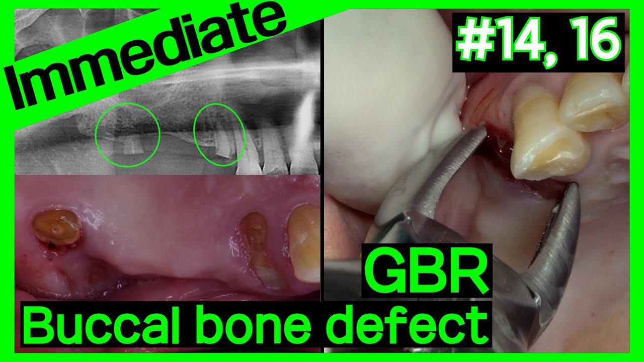 [Online Surgery] Immediate implant placement(#14, #16) with GBR - YouTube