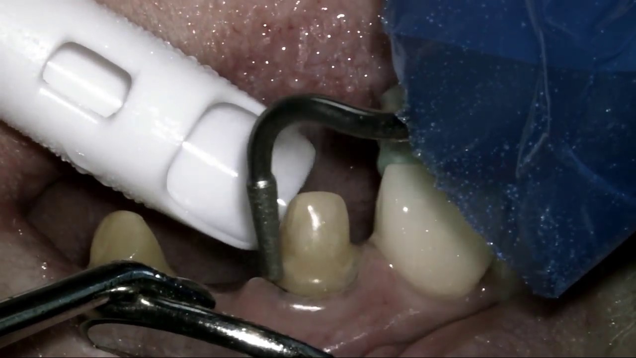 #9-11 Bridge Preparation Part 3 - YouTube