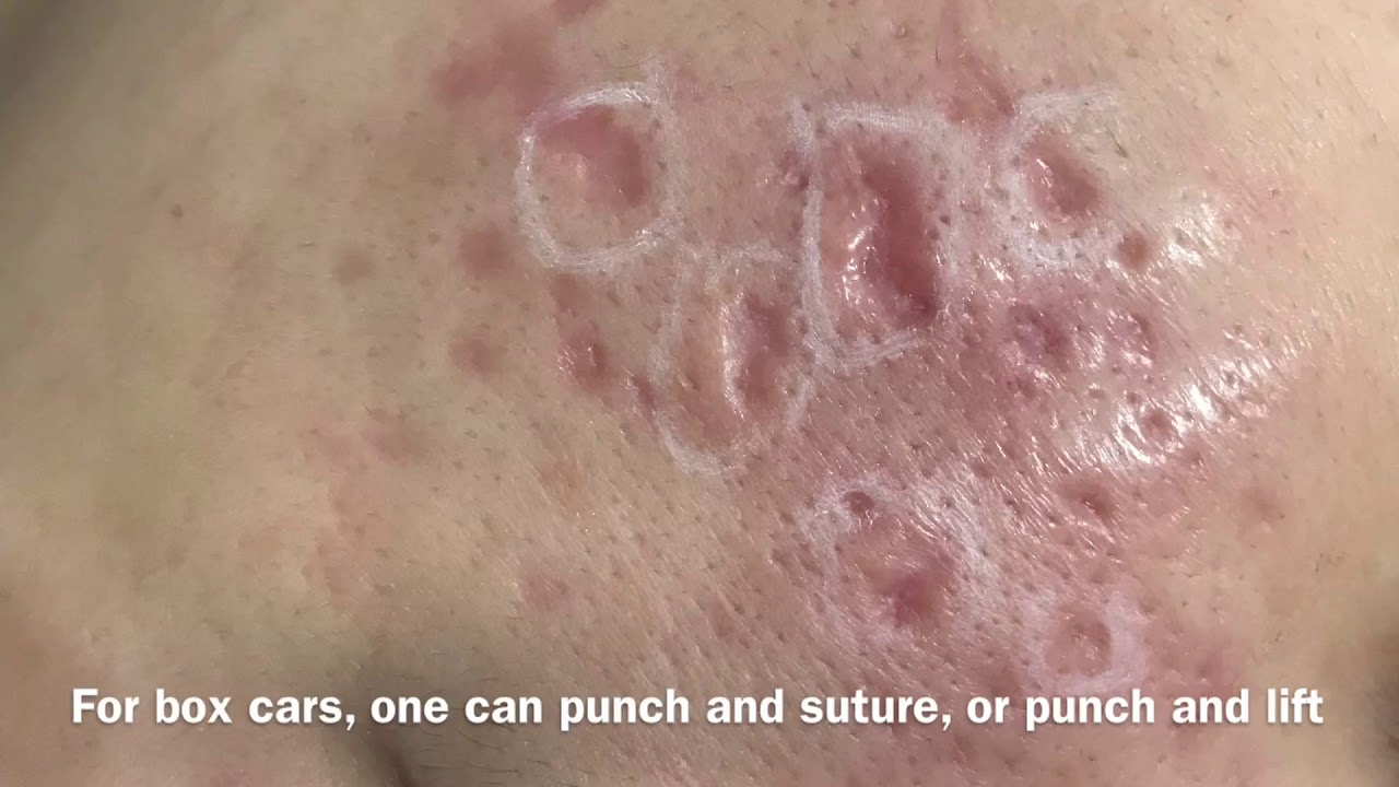 Acne scar punch/lift - YouTube