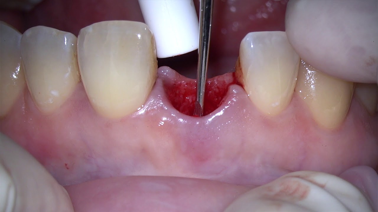 Immediate Implant with immediate crown - YouTube