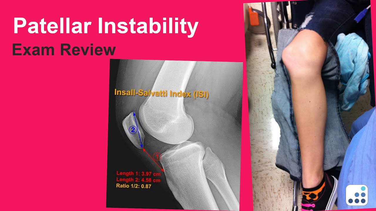 Patellar Instability Exam Review - C. Lowry Barnes, MD - YouTube