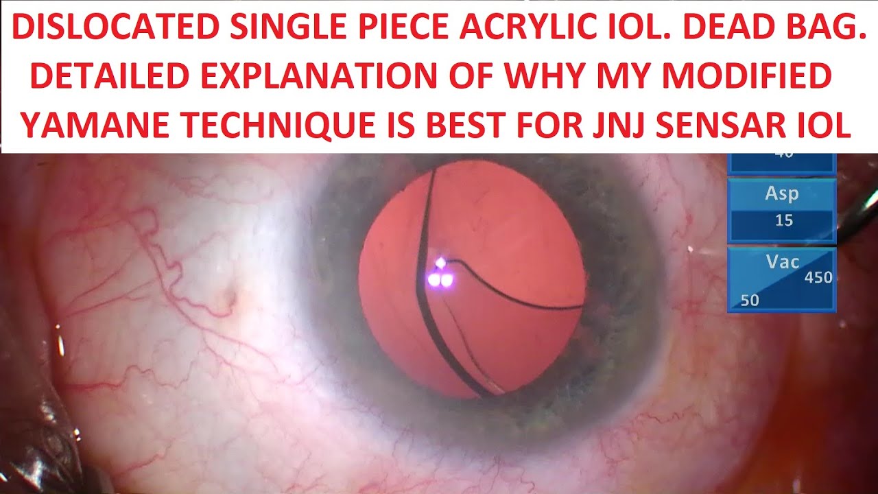 Dislocated SPA IOL. Dead Bag. Explanation Why My Modified Yamane ...