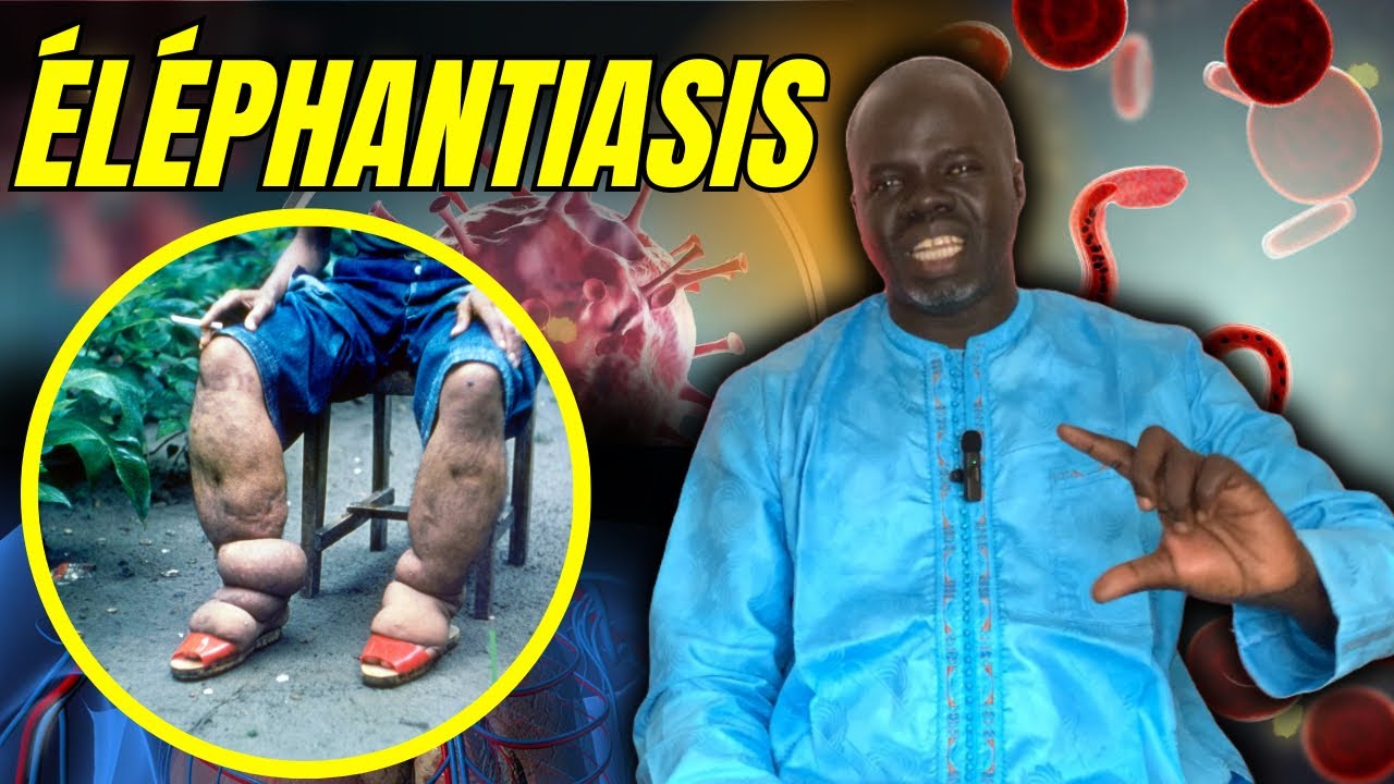 Elephantiasis Youtube