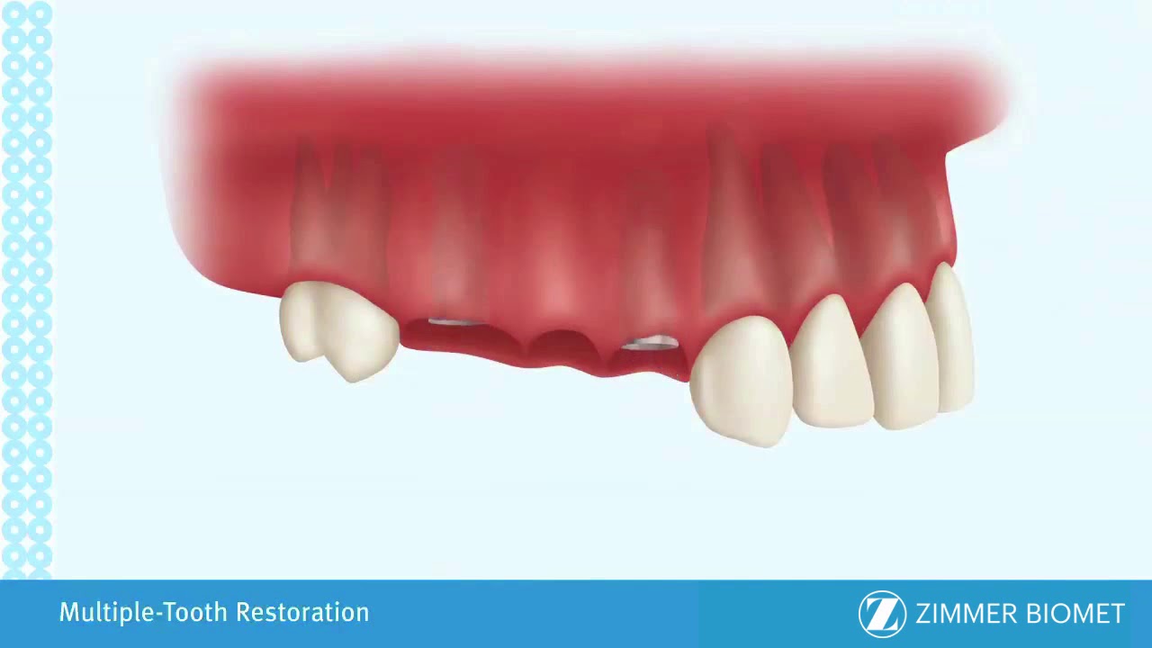 Multiple Tooth Restoration | Dental Implants Washington DC - YouTube