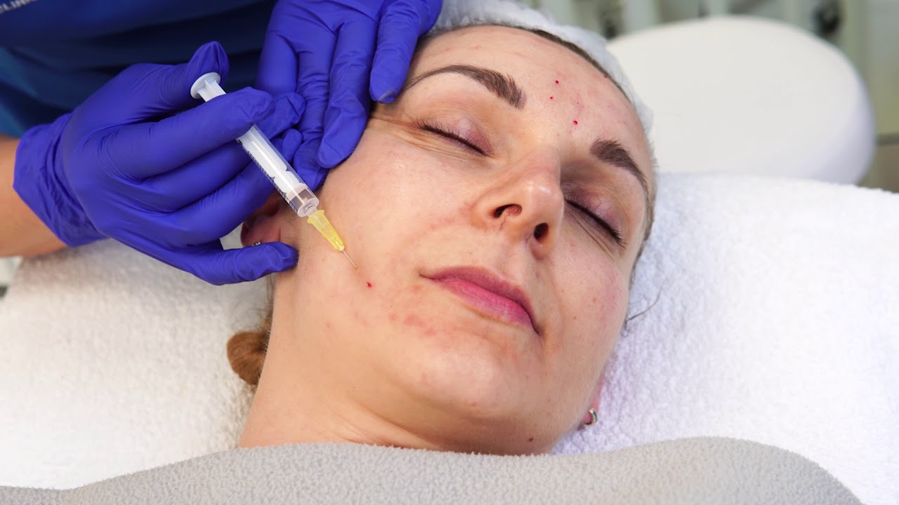 Needle Mesotherapy treatment - YouTube