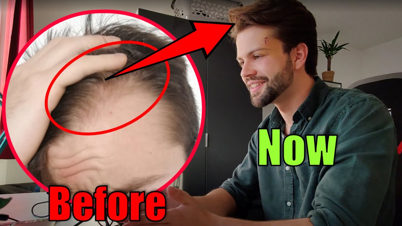 How I Stopped Balding! (no Hair Surgery) - YouTube