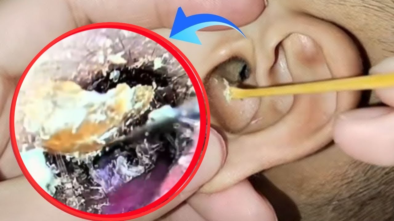 Disgusting Earwax Removal 🤢 | Deep Dry & Infected Ear Canal Cleaning ...