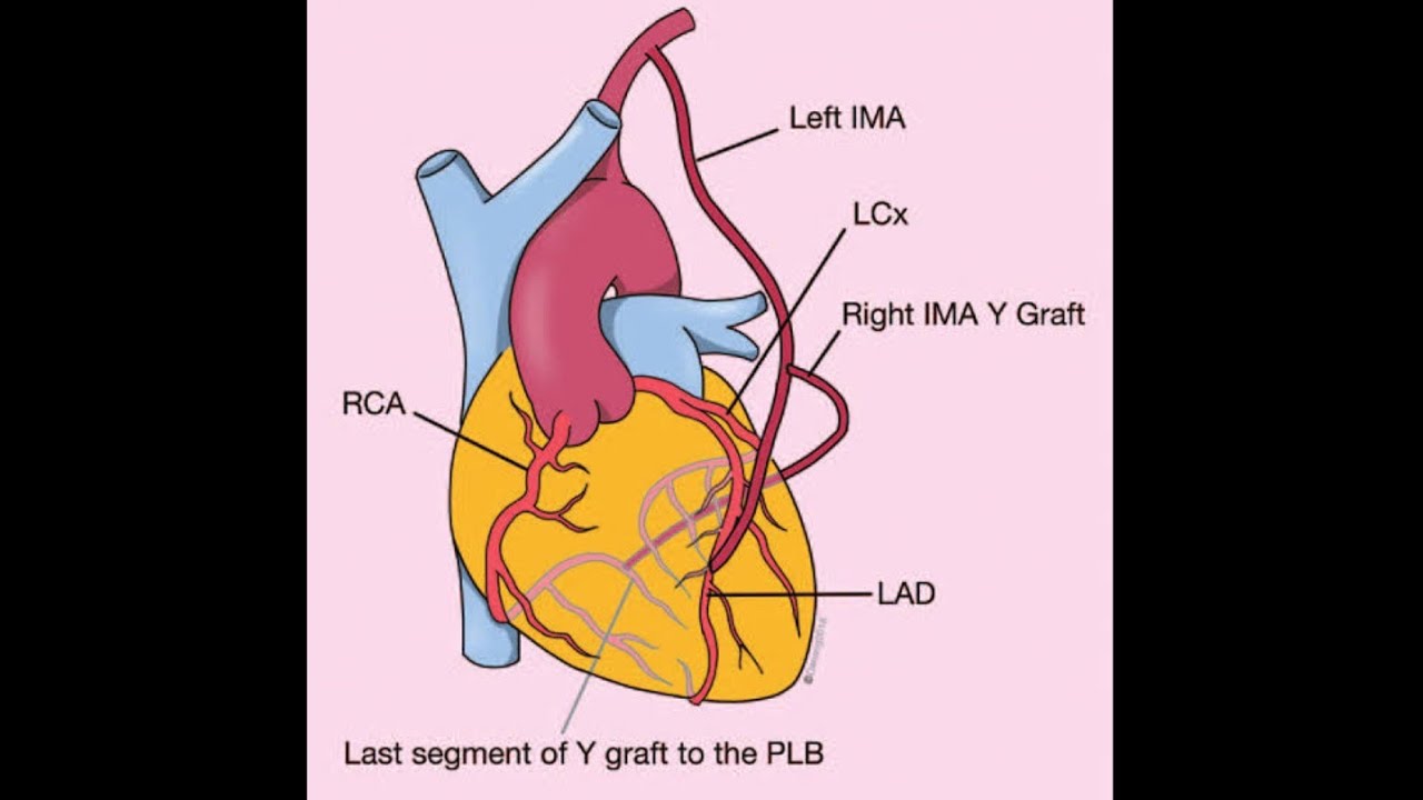 LIMA-RIMA-Radial artery Y graft. Beauty of LIMA-RIMA YGraft.#angiogram ...