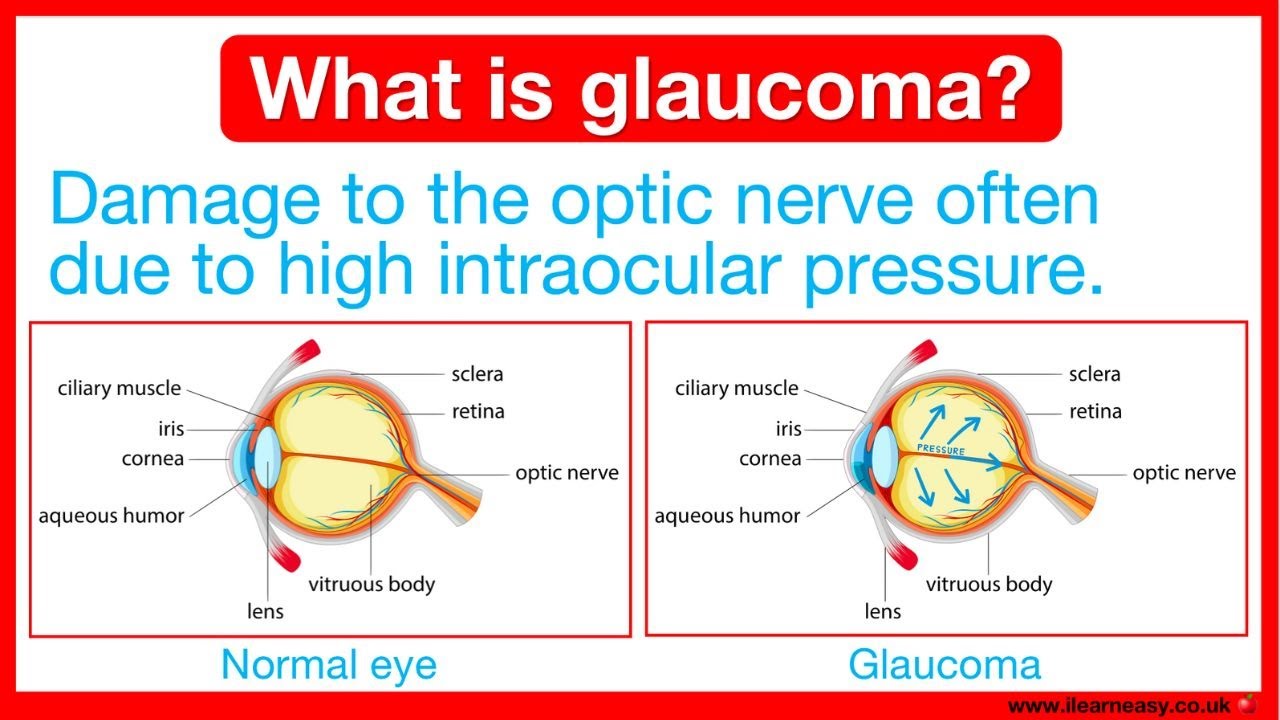What is glaucoma? 👁️ | Simple explanation | Causes, symptoms and ...
