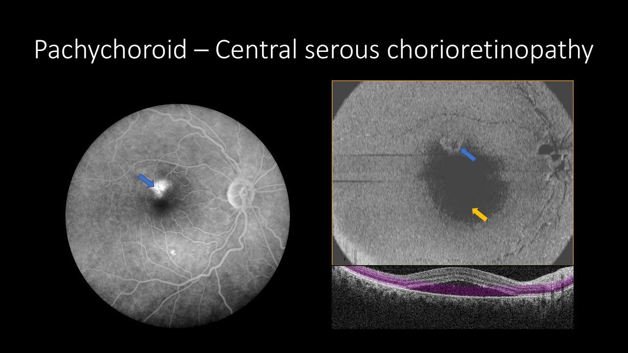 Structural Enface OCT- Choroidal vascular and Bruch’s membrane (PED and ...