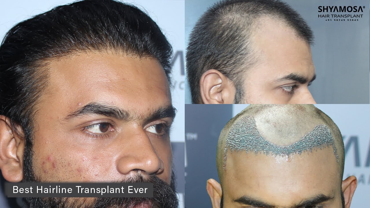 FUE Hair Transplant Results | Best Cost & Results of FUE Hair ...