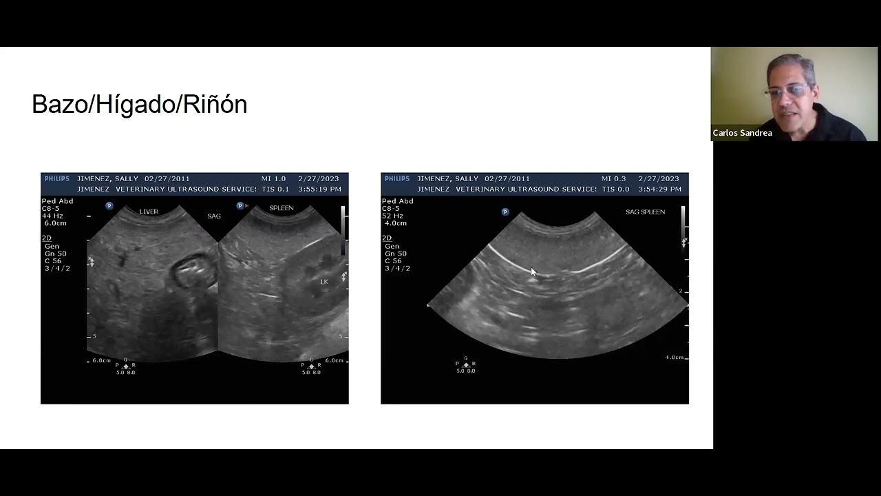 [Caso Clínico] Pancreatitis e hiperplasia endometrial quística por Dr ...