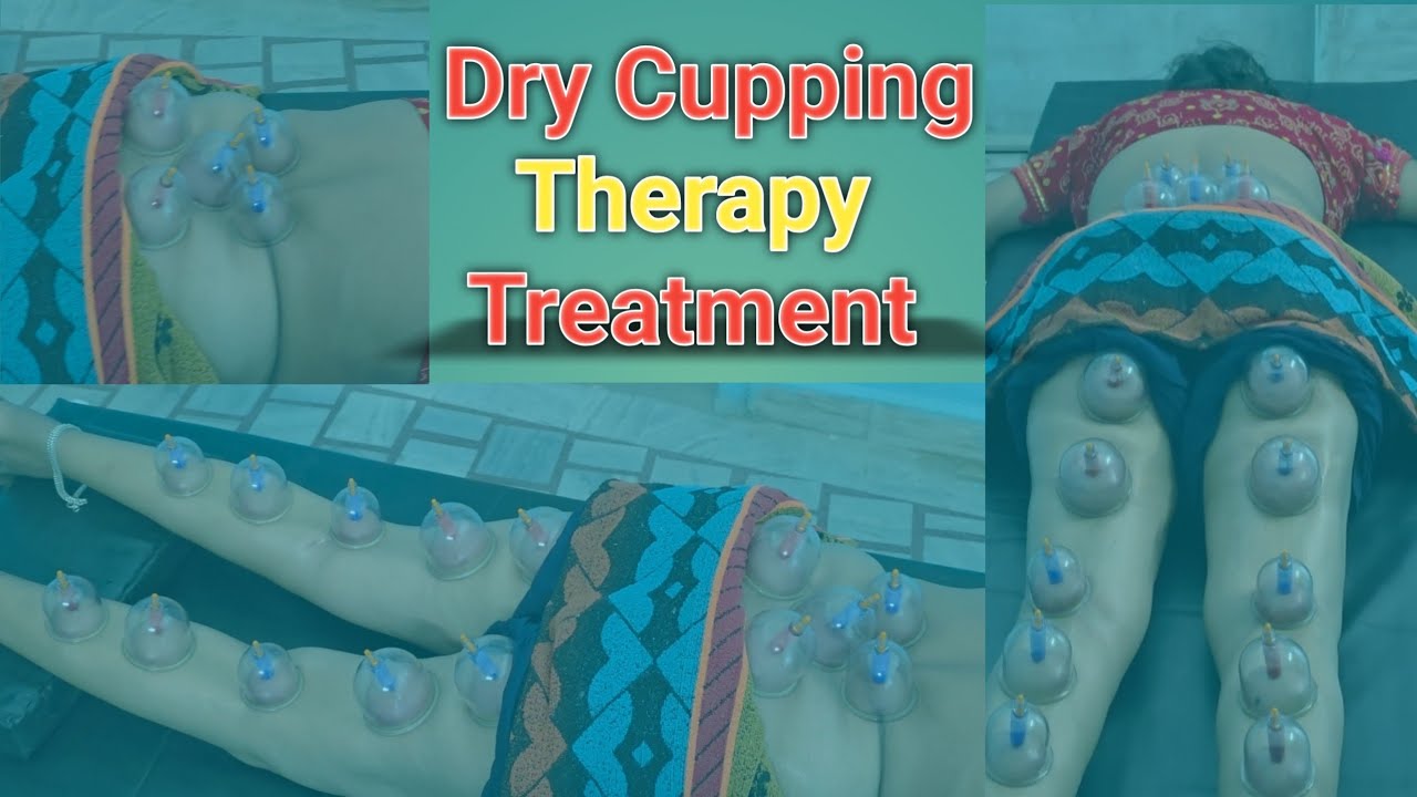 Cupping therapy treatment thigh pain waist - YouTube