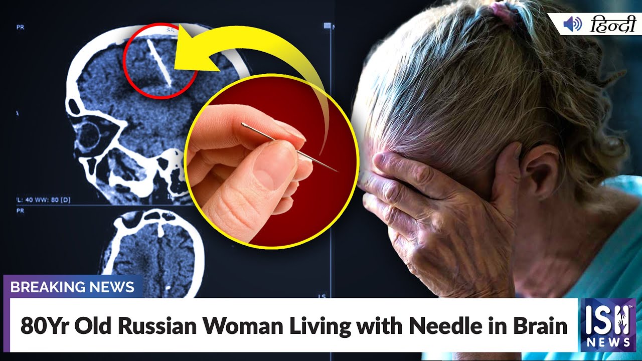 80Yr Old Russian Woman Living with Needle in Brain | ISH News - YouTube