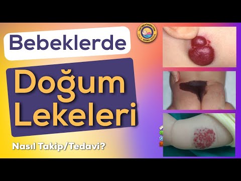 Bebek Doğum Lekeleri ve Döküntüler (Ne Zaman Kaybolur, Önemi Nedir...)
