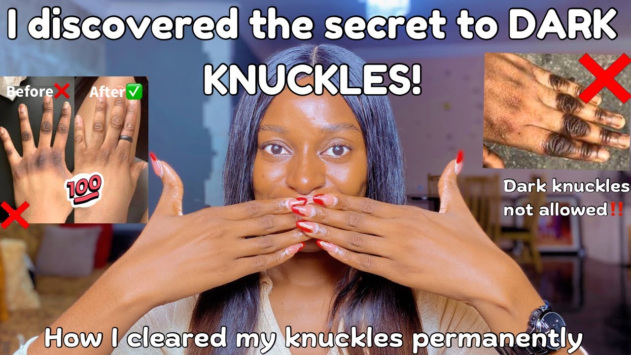 I cleared dark knuckles in just 1 week! | most effective way to clear ...