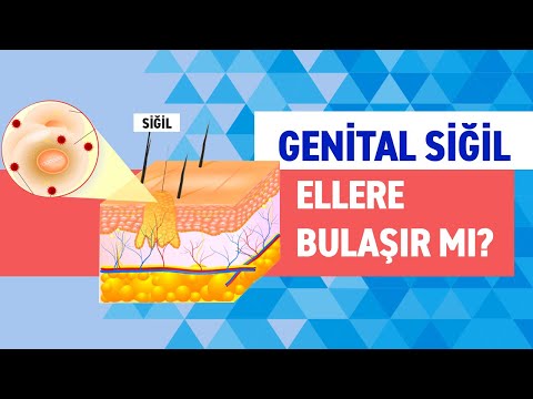 Genital Siğiller Bulaşıcı Mı? El Siğilleri Kimlerde Görülür?