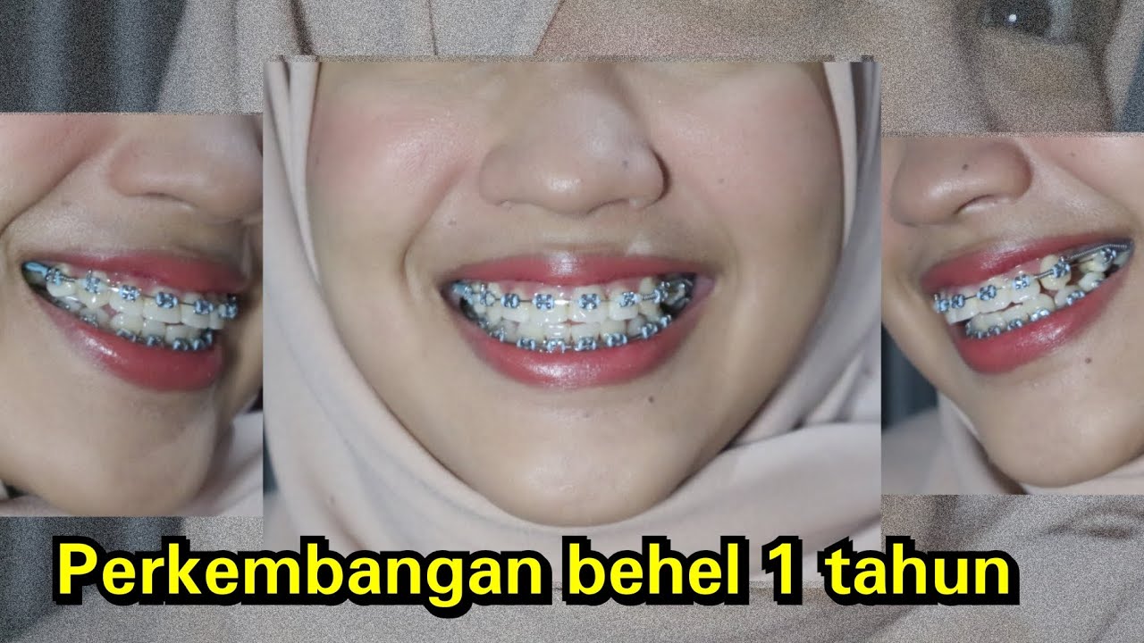 PERKEMBANGAN SETELAH 1 TAHUN PAKAI BEHEL - YouTube
