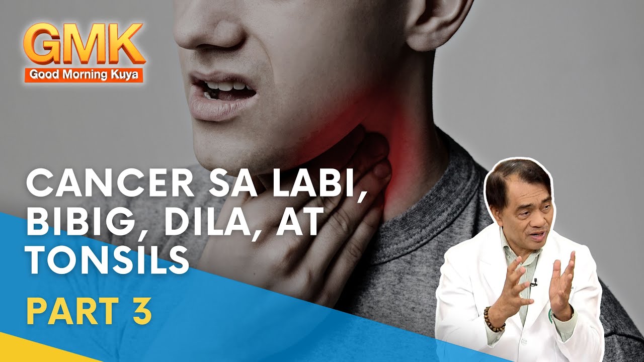Cancer sa Labi, Bibig, Dila, at Tonsils (Part 3) | Usapang ...