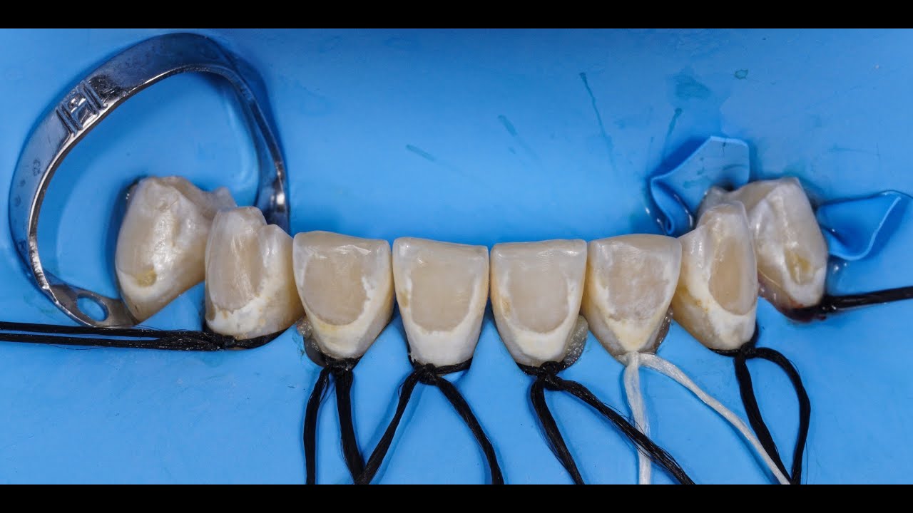 Resin infiltration technique - Icon alternative - YouTube