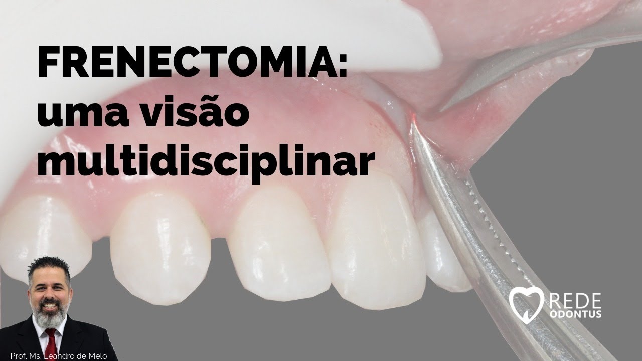 FRENECTOMIA: uma visão multidisciplinar. - YouTube