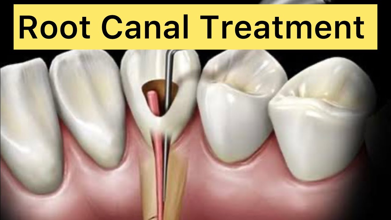 “Root Canal Treatment-Step By Step “ - YouTube