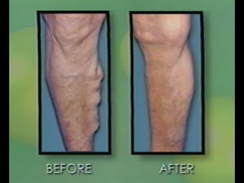 Varicose Vein Treatment by Laser - Endovenous Saphenous Vein Ablation ...