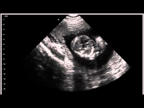 Fetal Heartbeat, ultrasound - YouTube