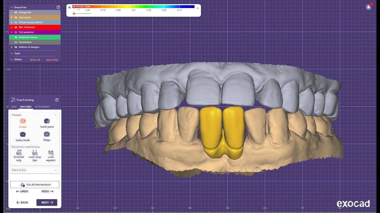 Lower Anterior designing in Exocad for durable prosthesis - YouTube