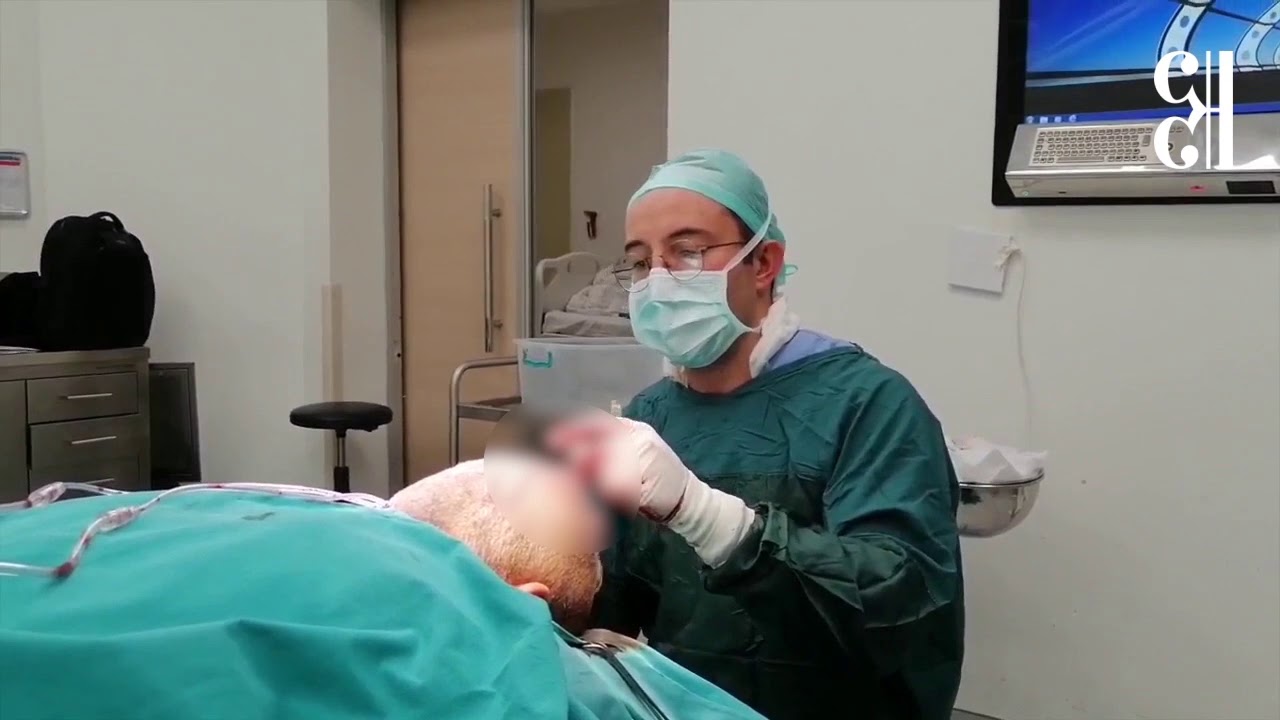 Cutis Verticis Gyrata - YouTube