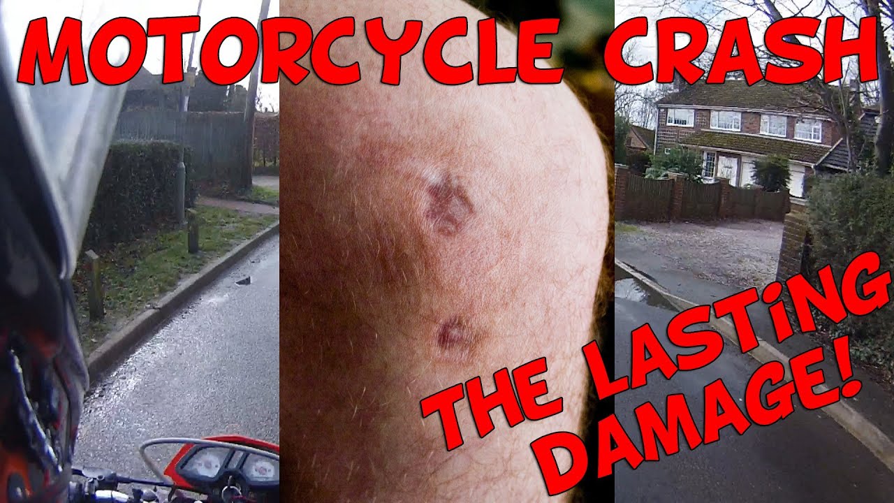 Motorcycle crash, The lasting damage! - YouTube