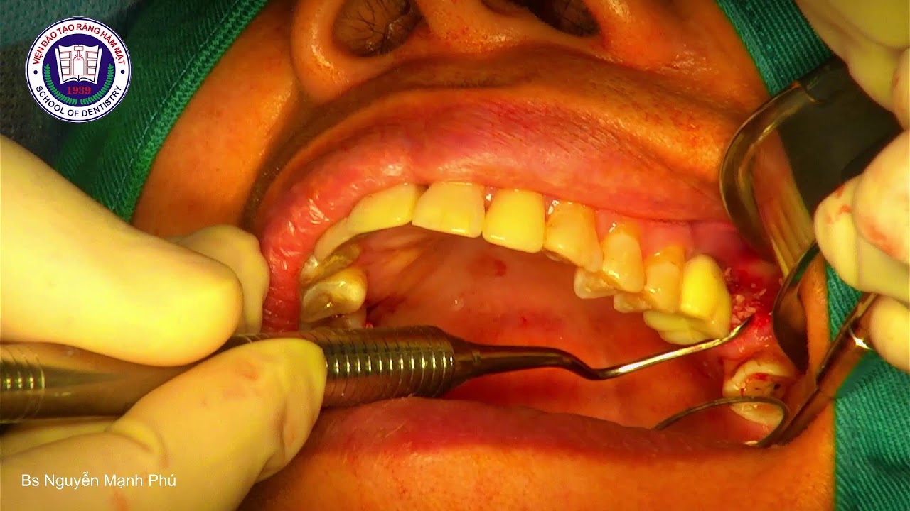 Phẫu thuật đặt trụ lành thương + ghép xương vùng răng 17- 27 Amgraft ...