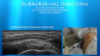 Ultrasound guided Subacromial injection ...from probeul... | Doovi