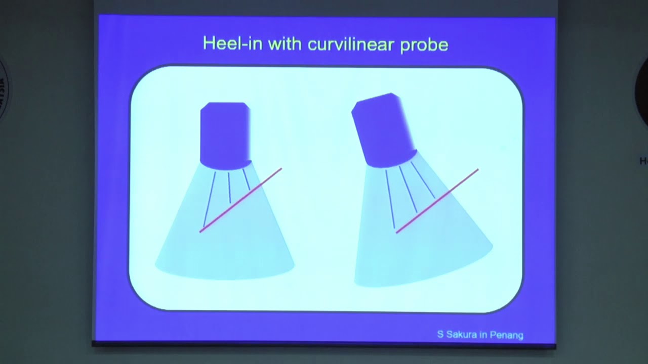 How to Improve Needle Visualization in Ultrasound Guided Regional ...