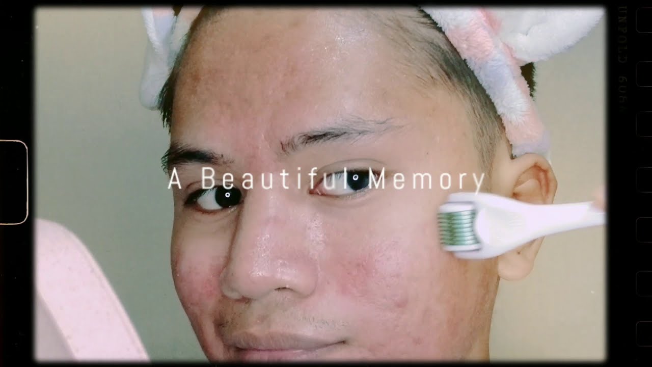 Derma Roller for Acne Scars and Marks - YouTube