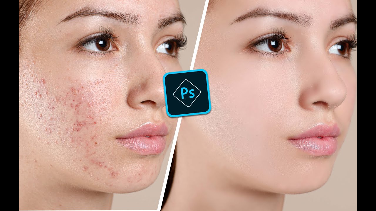 [ วิธีลบสิว แต่งผิวเรียบเนียน ] How to remove acne, smooth skin with ...