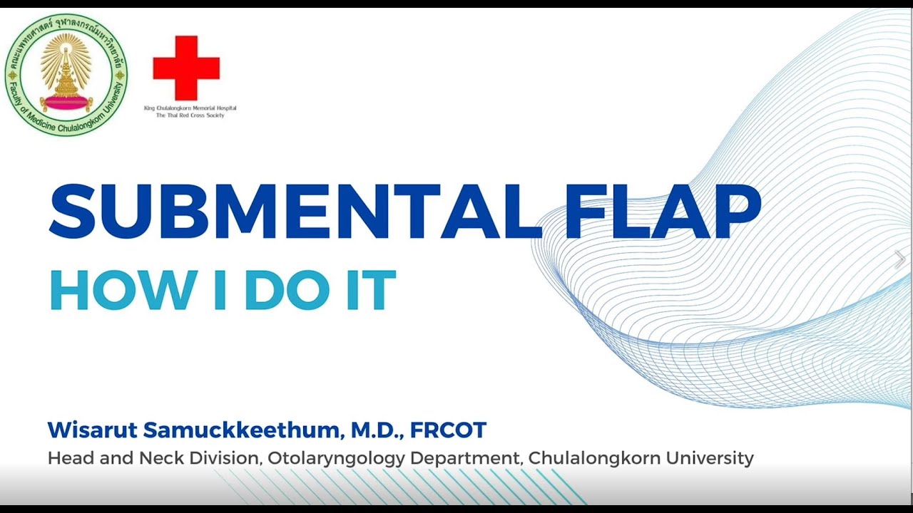 Submental flap Aj Wisarut Final - YouTube