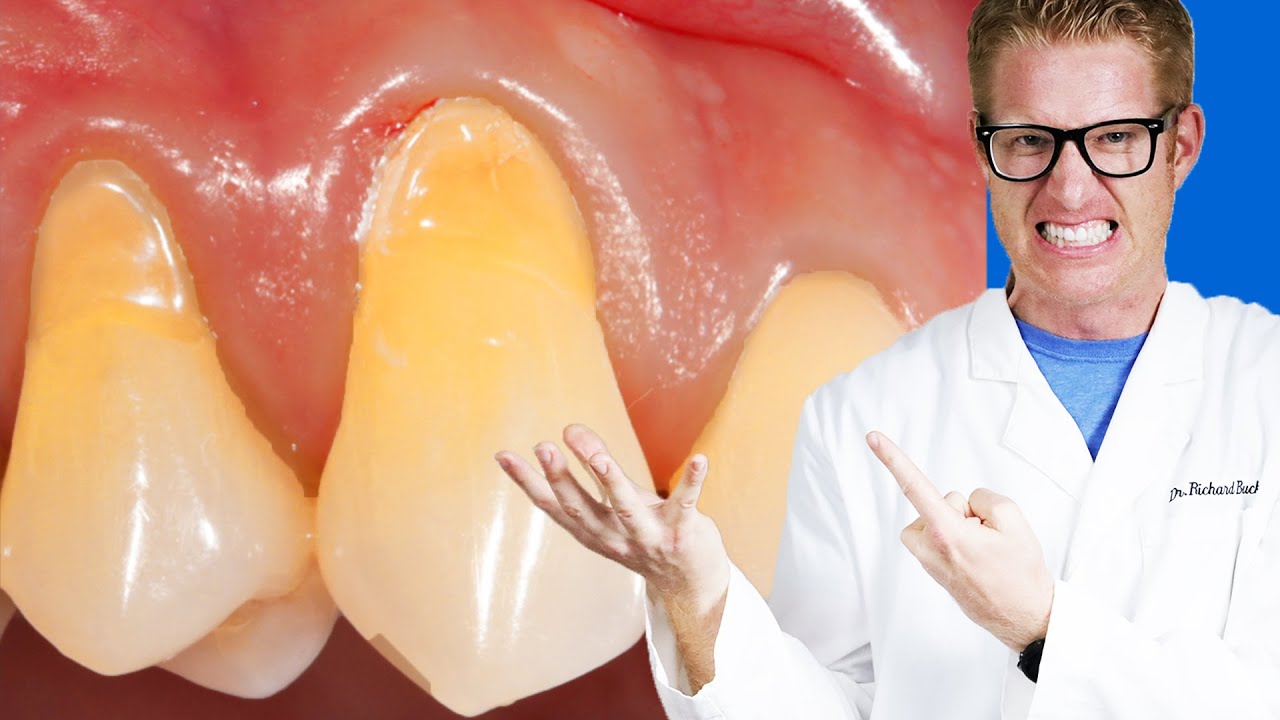 Dentist Explains Every Cause Of RECEDING GUMS How To Stop Gum Loss Dentist Explains Every Cause Of RECEDING GUMS How To Stop Gum Loss