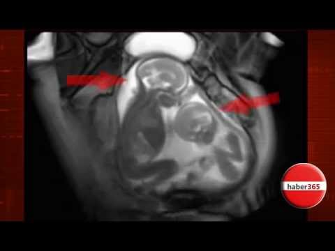 Əkiz uşaqların ana bətnindəki davası!   VİDEO