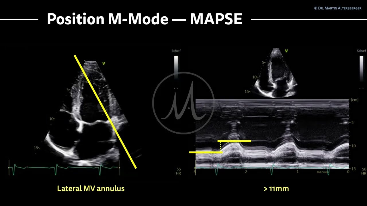 Echocardiography MAPSE Left Ventricular Function With M Mode YouTube Echocardiography MAPSE Left Ventricular Function With M Mode YouTube