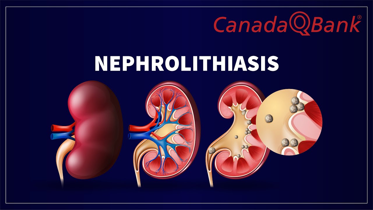 Nephrolithiasis: Causes, Symptoms, Diagnosis & Treatment | CanadaQBank - YouTube