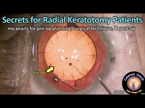 Cataract 1227: secrets for radial keratotomy patients having cataract ...