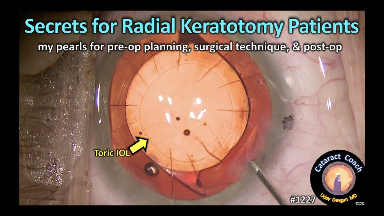 Cataract 1227: secrets for radial keratotomy patients having cataract ...